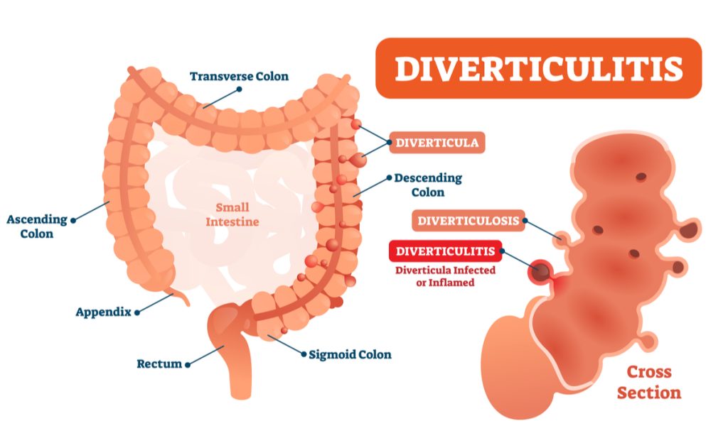 Understanding How to Prevent Diverticular Disease – Precision Digestive ...